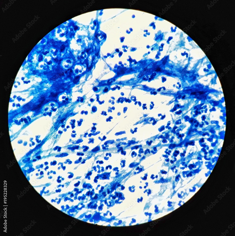 Foto de Stock Smear of Acid-Fast bacilli (AFB) stained from sputum ...