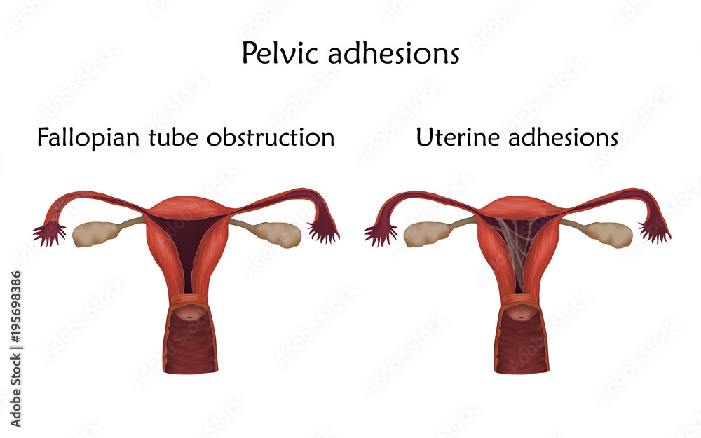 Pelvic adhersions. Uterine adhesions and fallopian tube obstruction ...