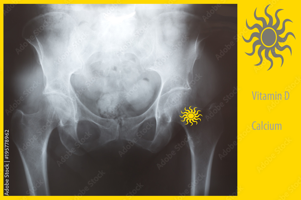Prevention of osteoporosis and hip fracture concept. X-ray of female ...
