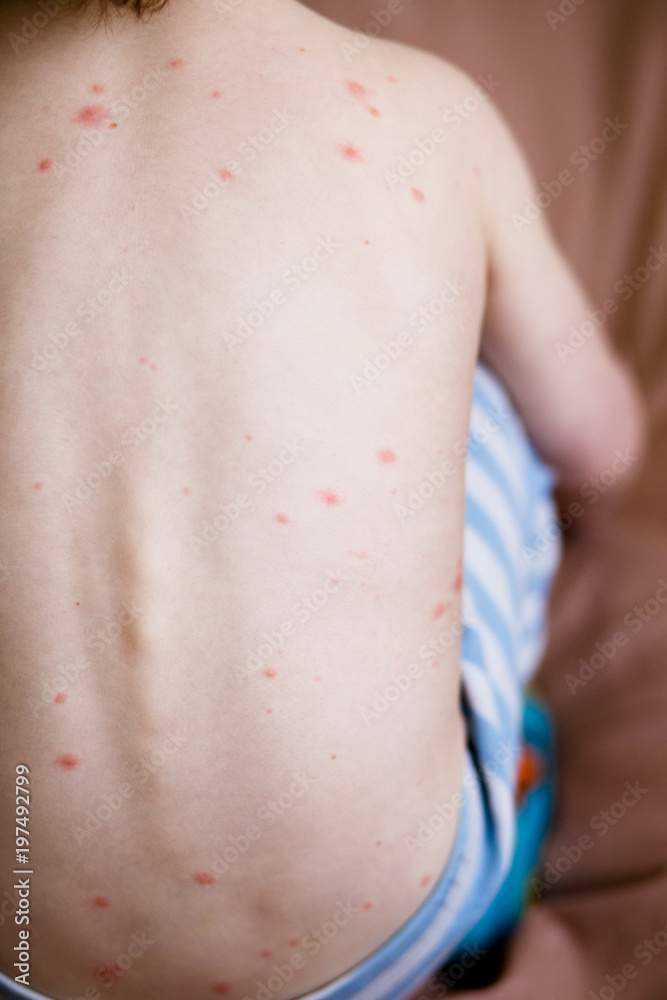 Baby with chicken pox rash. Varicella virus or Chickenpox bubble rash ...