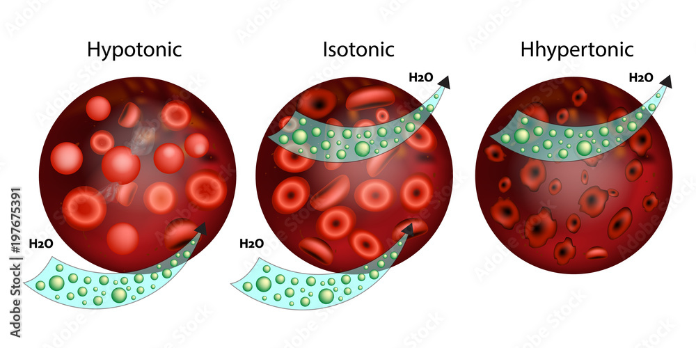 Effect of different solutions on blood cells.The effect of osmosis on cells. Hypotonic, Isotonic ...
