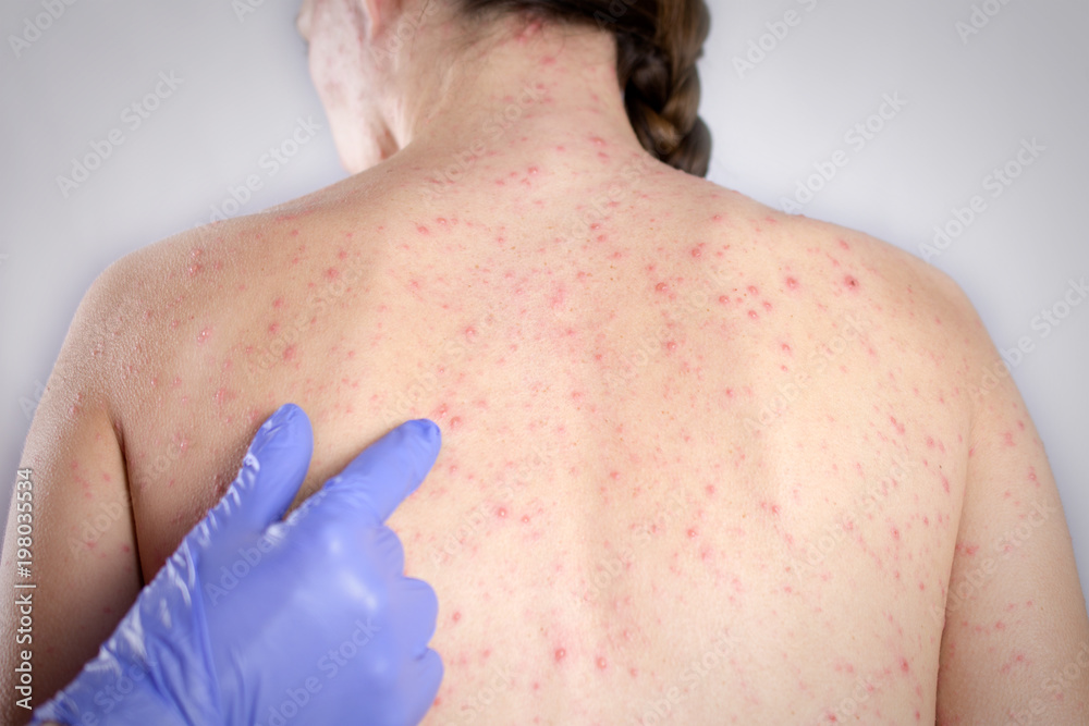 Rubella concept. girls back skin bubble rash Stock Photo | Adobe Stock