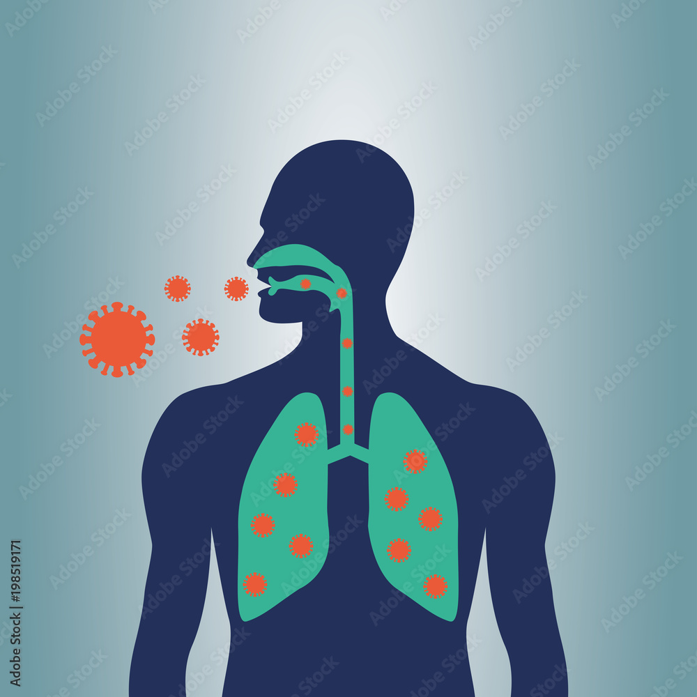 Sars disease-illustration Stock Vector | Adobe Stock