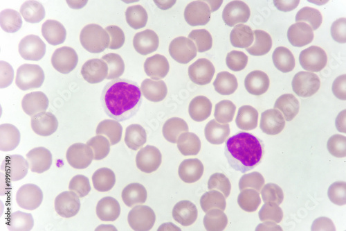 Lymphocyte cells (white blood cell) in blood smear, analyze by ...