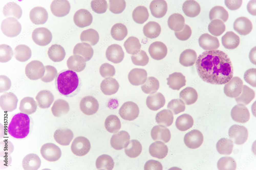 Blood smear of chronic lymphocytic leukemia (CLL), analyze by ...