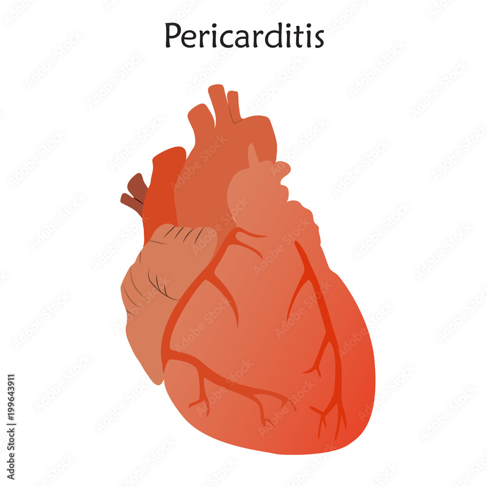 Pericarditis. Inflammation of the pericardium. Damaged heart muscle ...