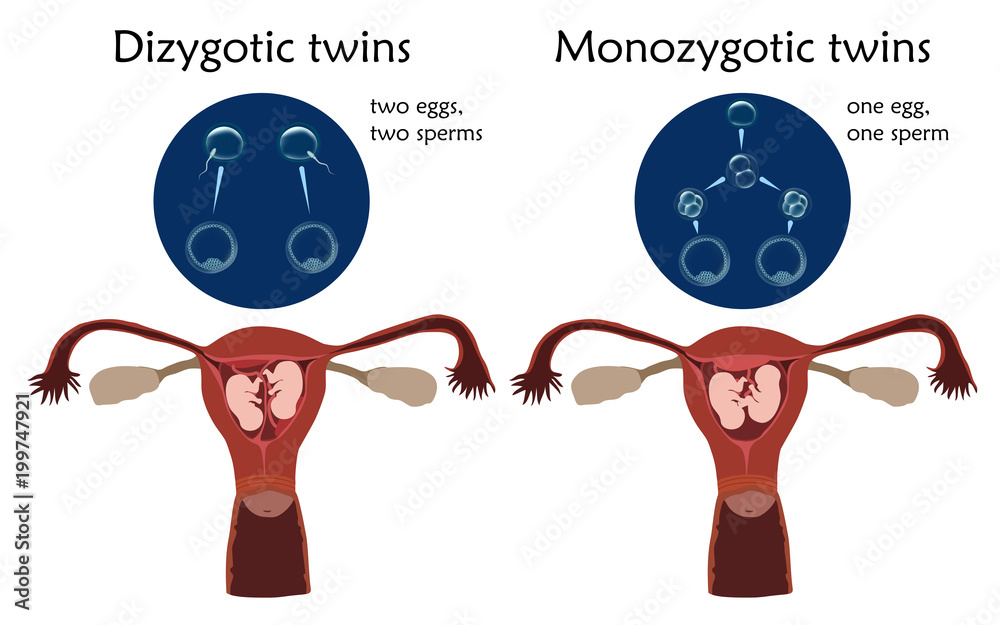 Multiple pregnancy. Dizygotic and monozygotic twins, embryo, fetus in ...