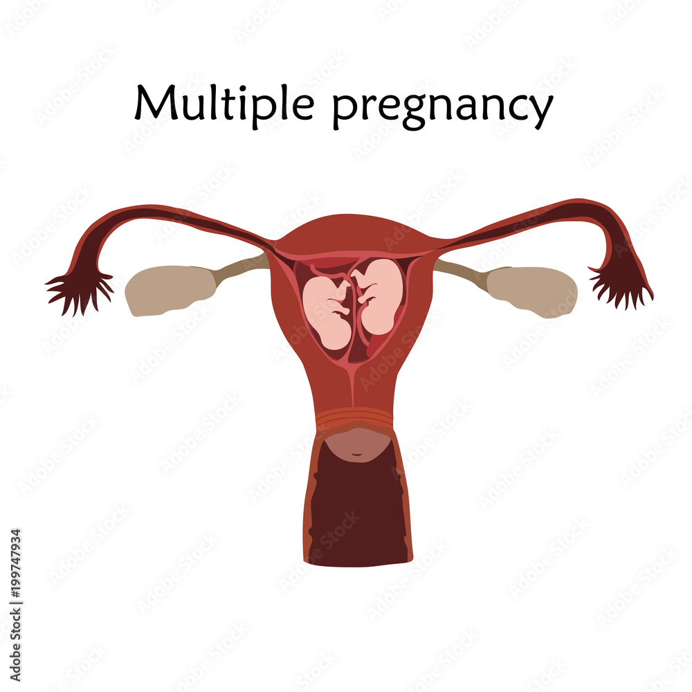 Multiple pregnancy, twins, embryo, fetus in uterus, placenta, umbilical ...