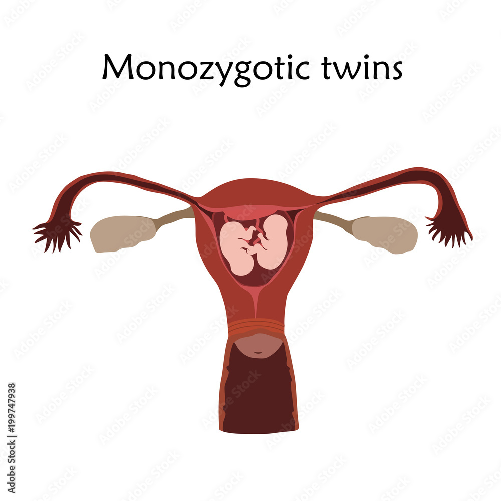 Multiple pregnancy. Monozygotic twins, embryo, fetus in uterus ...