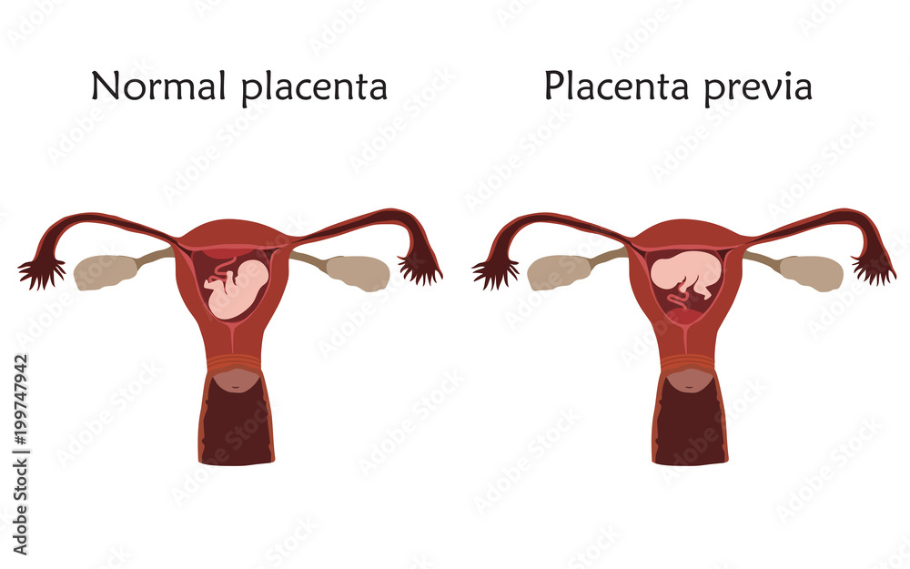 Placenta previa and normal pregnancy. Embryo, fetus in uterus, placenta ...