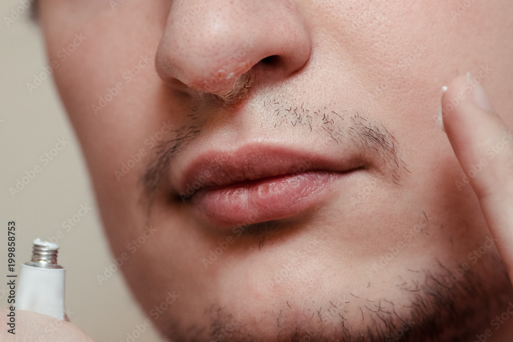 Herpes on lips of the young man. Shocked man touching pain her nose ...