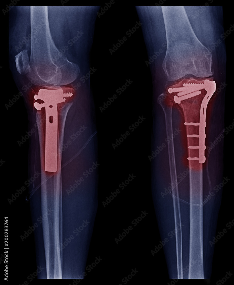 X-ray image of bone fracture at Tibia and Fibular right leg Open ...