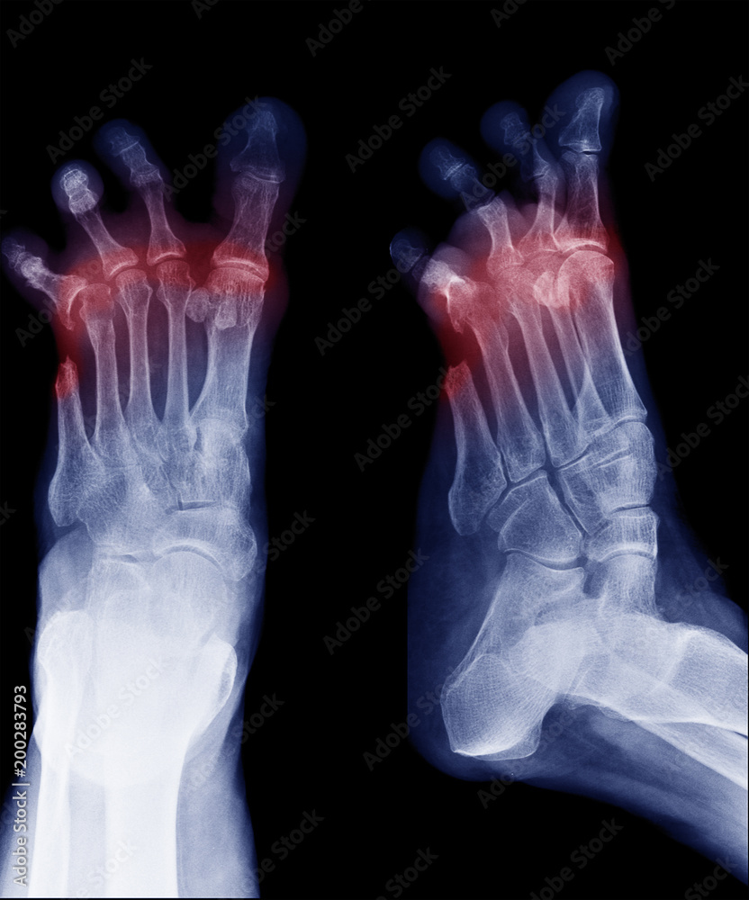 X-ray image of diabetic foot amputation, AP and oblique view ...