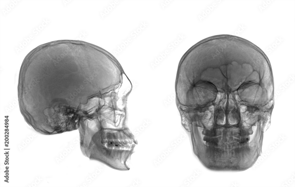 Very good quality X-ray image of normal human skull front (AP) view and ...