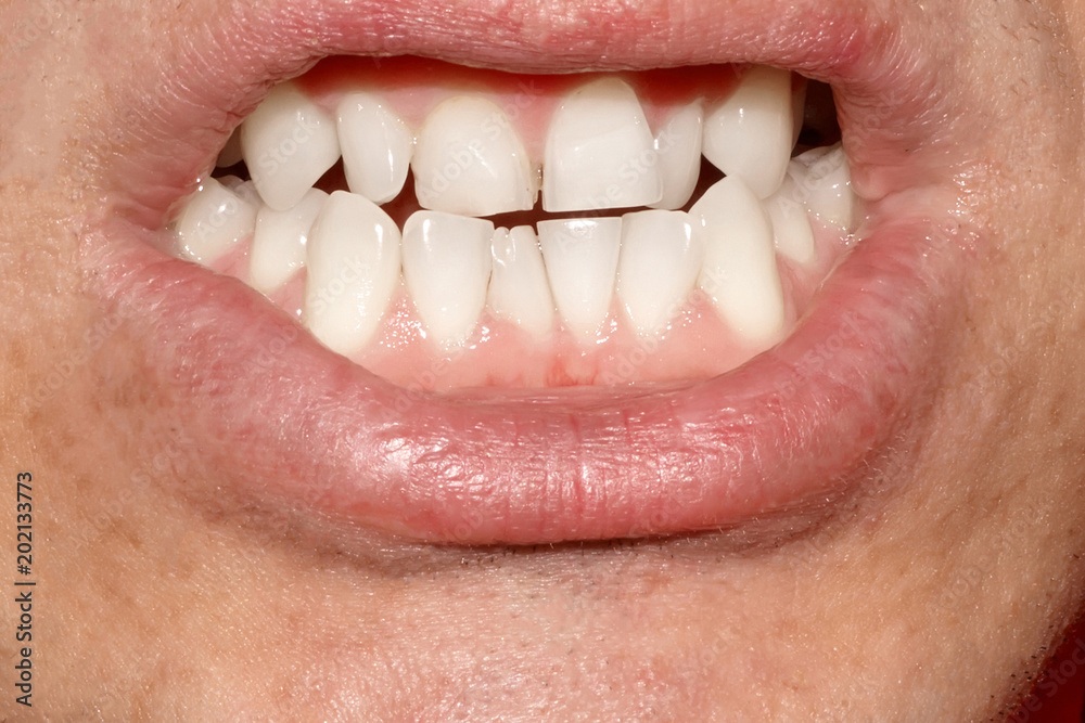 Ugly teeth with terrible smile. Portrait of close up man with crooked ...