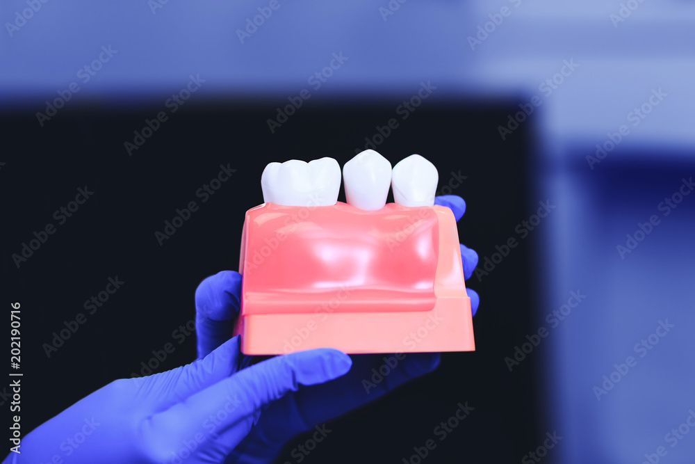 Dental implants and tooth in the hands of real doctor. Dental crown ...
