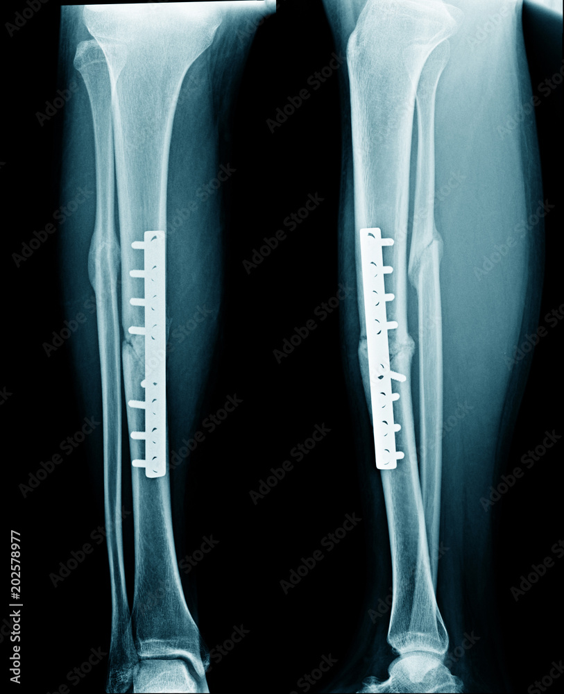 fracture leg both bone, x-ray image show fixation of tibia bone and ...