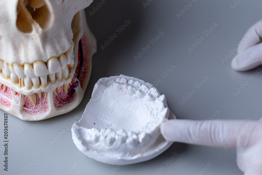 Foto de Stock Study cast of Diagnostic cast and dental gypsum models in ...