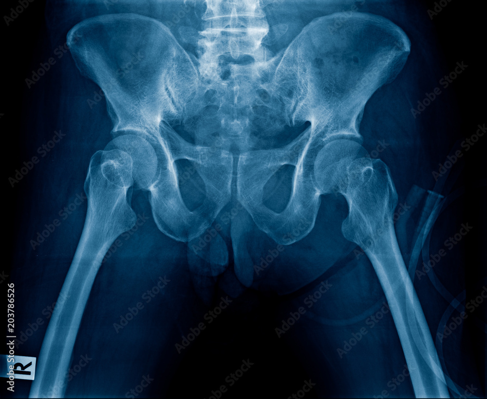 OA hip and joint pain with deformity of hip joint both side Stock Photo ...