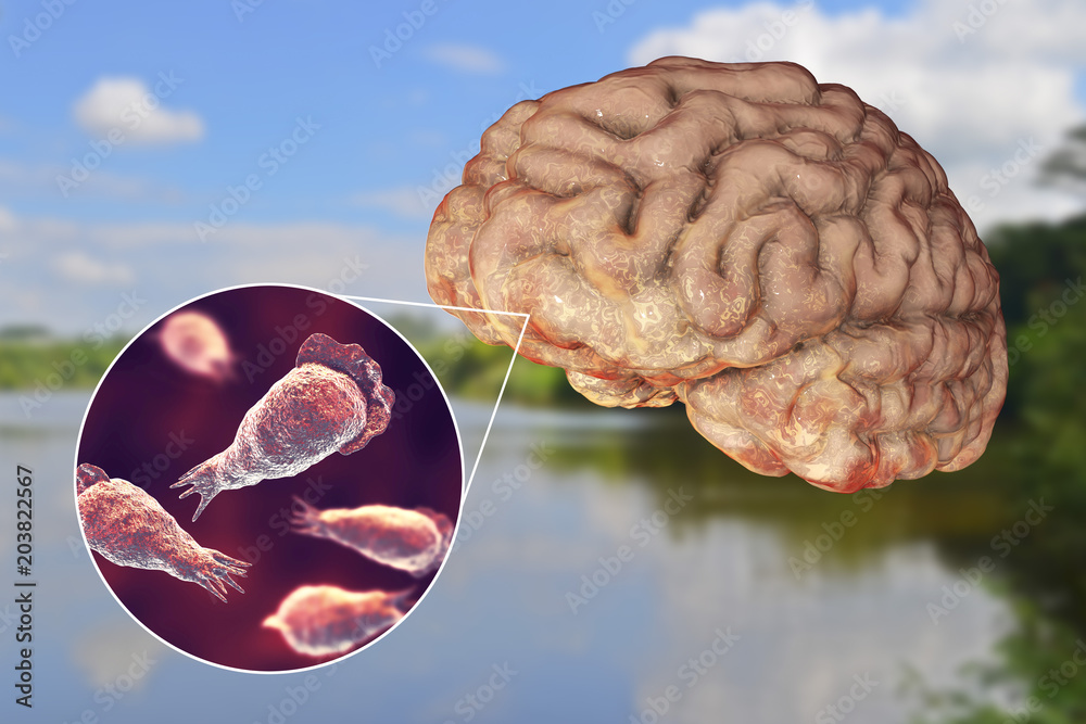 Brain-eating amoeba infection, naegleriasis. Trophozoite form of the ...