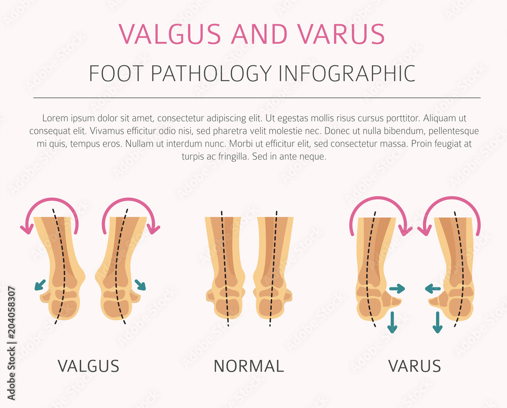 Foot deformation as medical desease infographic. Valgus and varus defect Stock Vector | Adobe Stock