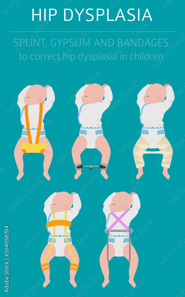 Foot deformation types, medical desease infographic. Hip dysplasia in ...