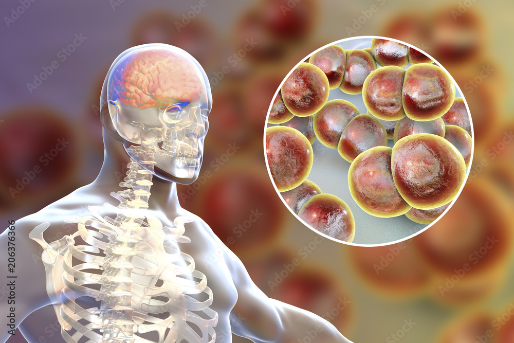 Brain infection with Neisseria meningitidis bacteria, 3D illustration ...
