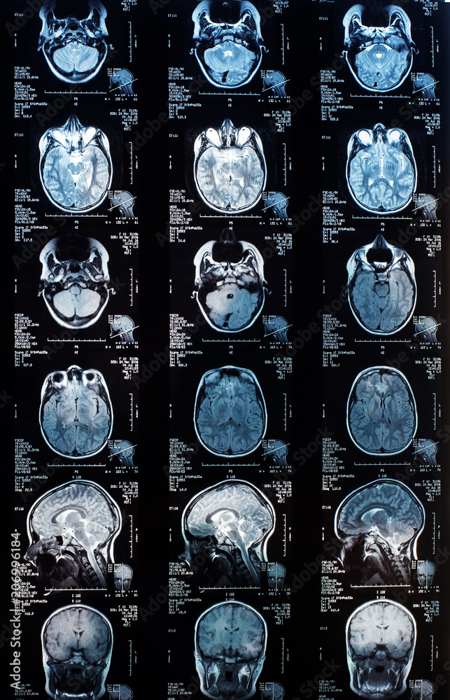 magnetic resonance image (MRI) of the brain Stock Photo | Adobe Stock