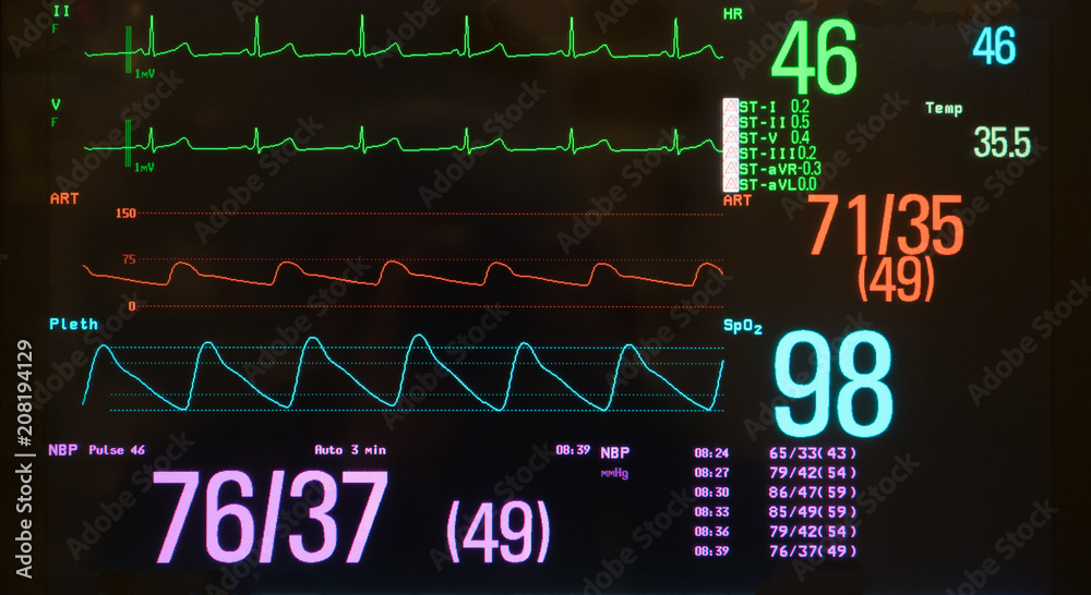 Monitor with Bradycardia on the ECG and Hypotension on the red arterial ...