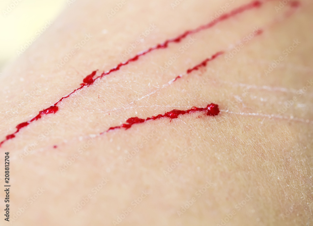 patients with deep wounds and scratches with drops of blood on human ...