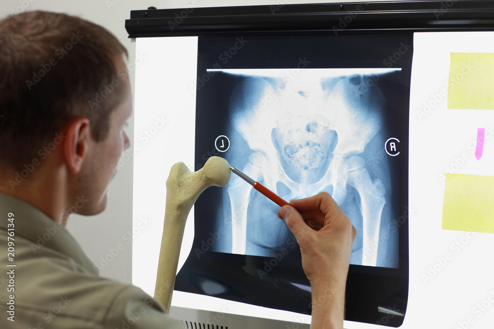 Professional with femur bone model watching image of hip - joint ...