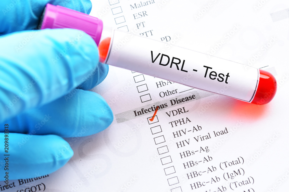 Blood sample tube with laboratory requisition form for VDRL test ...