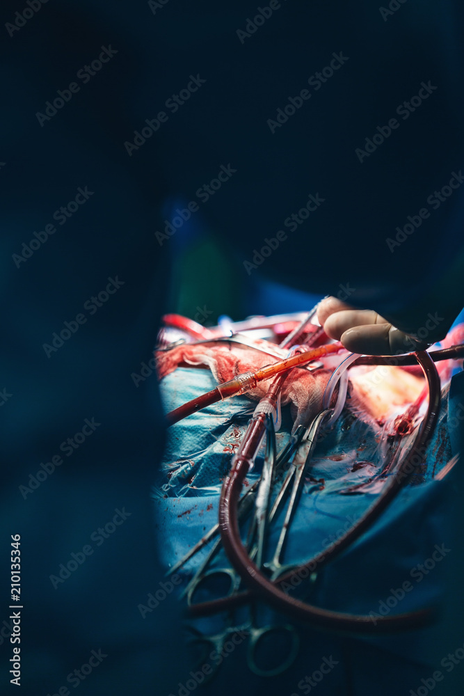 Close up of open heart surgery cardiopulmonary bypass, minimal invasive ...