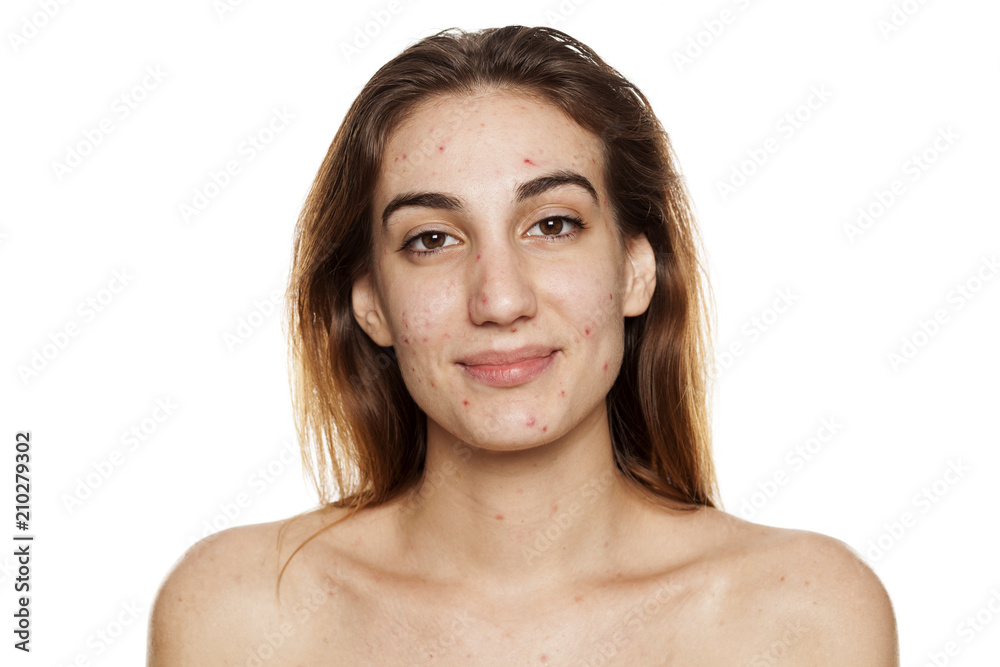 young smiling woman with problematic skin and without makeup poses on a ...