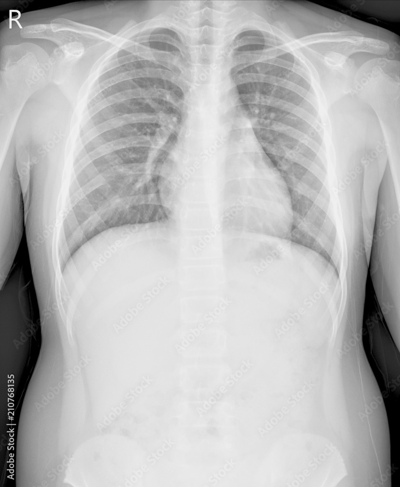 chest x-ray a boy 12 year old. show normal heart size and bony thorax ...