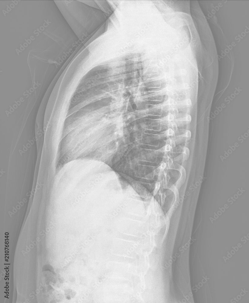 Chest x-ray lateral a boy 12 year old Normal heart size and bony thorax ...