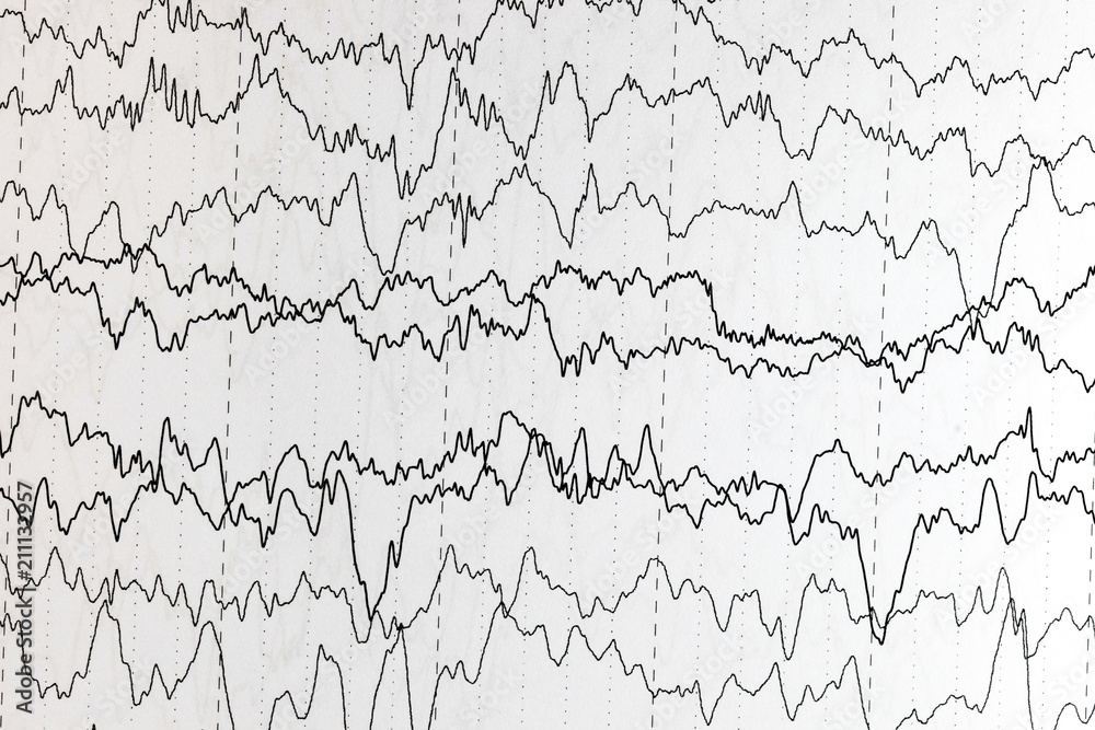 EEG of the pediatric patients, problems in the electrical activity of ...