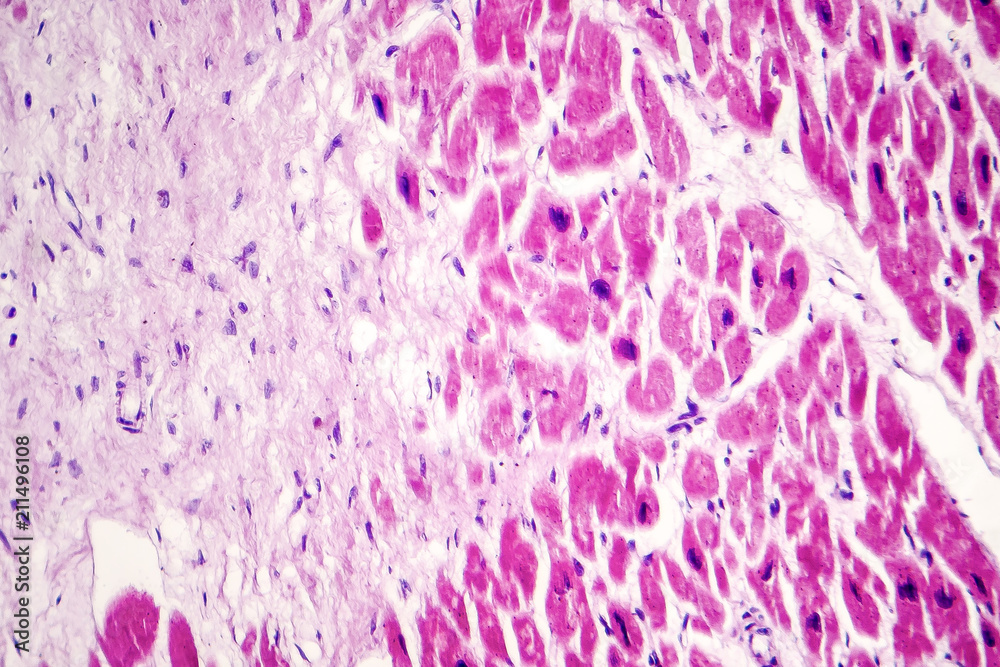 Acute myocardial infarction, histology of heart tissue, light ...