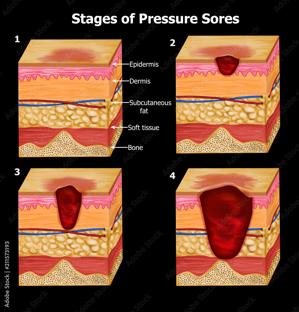 Stages of pressure sores Stock Illustration | Adobe Stock