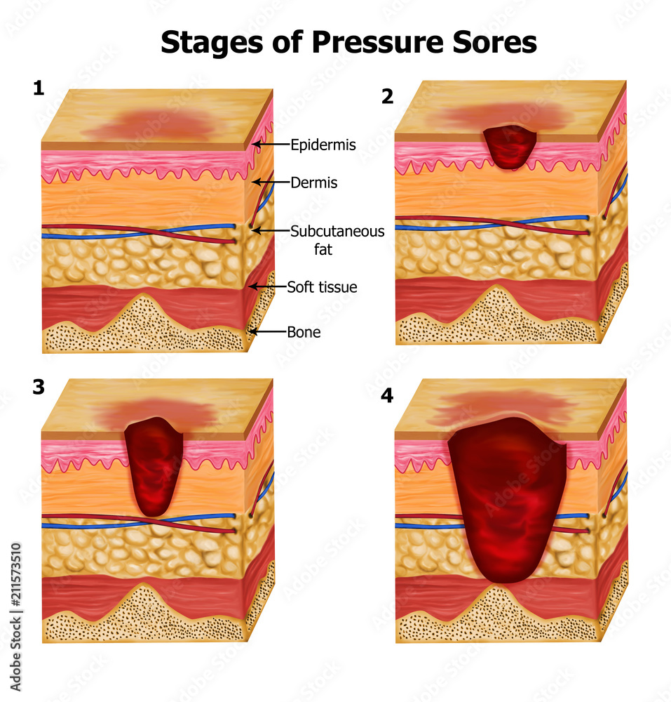 Stages of pressure sores Stock Illustration | Adobe Stock