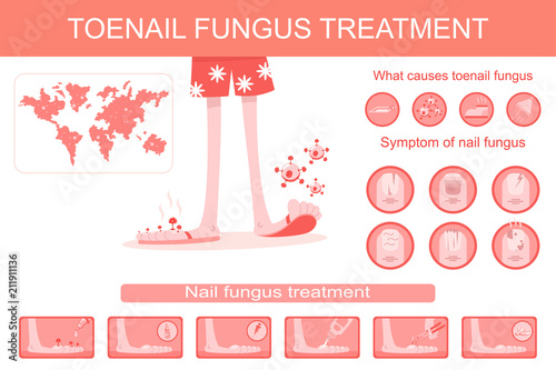 Toenail fungus treatment medical infographics. Vector cartoon flat ...