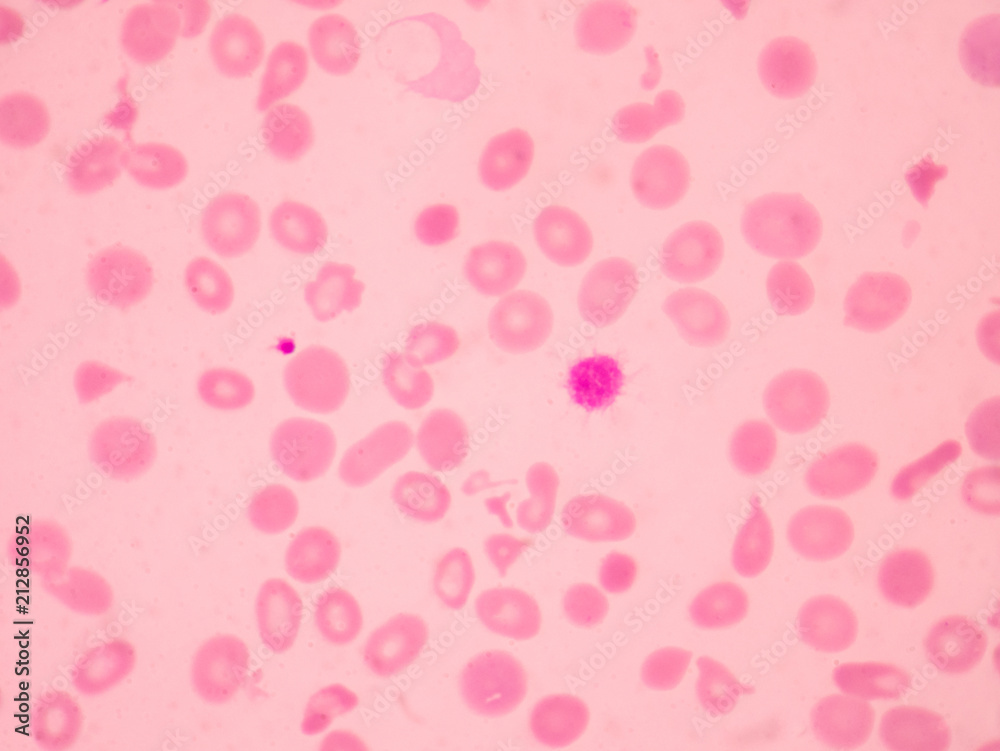 Thalassemia blood smear abnormal red blood cells morphology. Stock ...