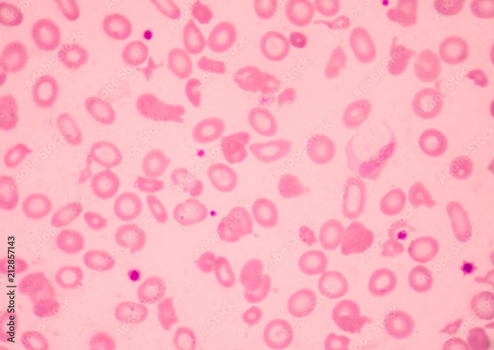Thalassemia blood smear abnormal red blood cells morphology. Stock ...
