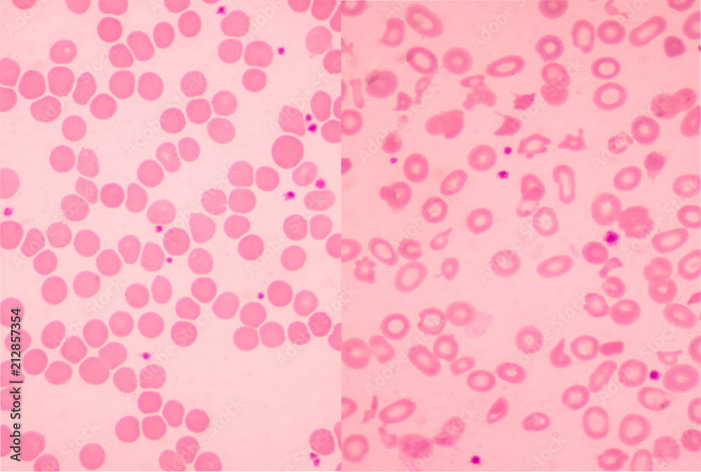 Left normal and right thalassemia blood smear. Stock Photo | Adobe Stock