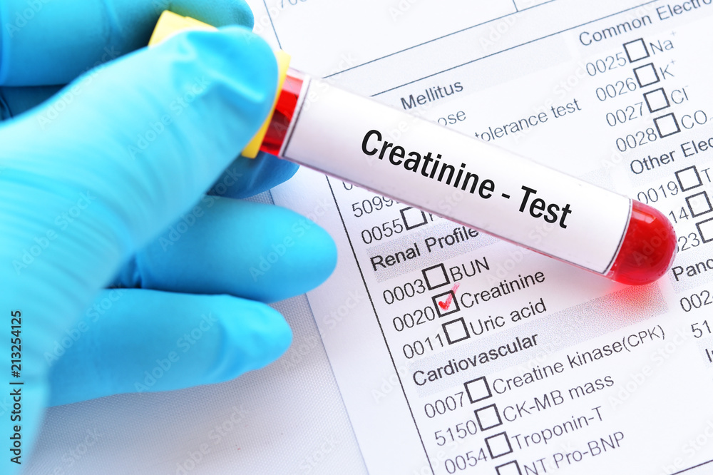 Blood sample for creatinine test, diagnosis for renal disease Stock ...