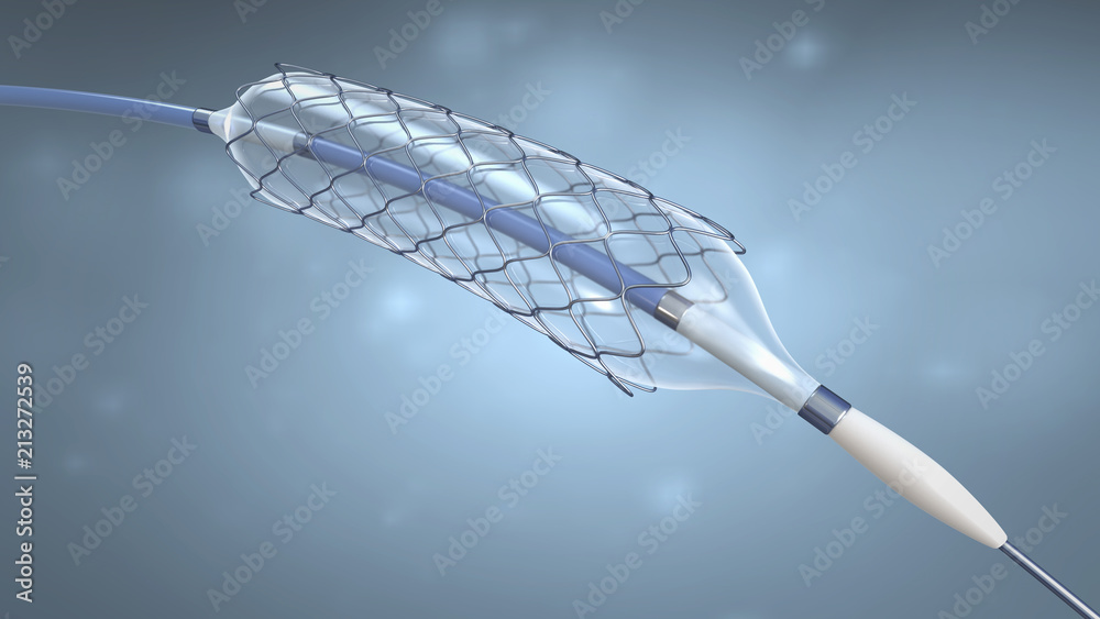 3d illustration of stent implantation for supporting blood circulation ...