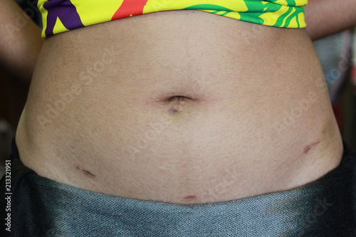 The scar of a young Asian women myoma case after myomectomy by ...