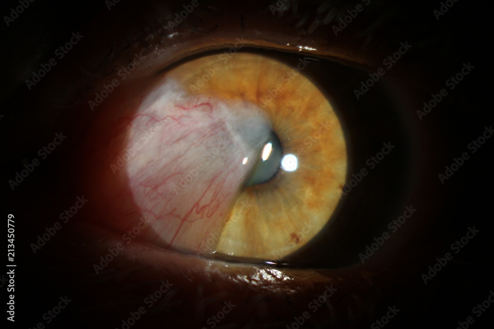 Human eye with cataract. Investigation and test of the eye fund us of ...