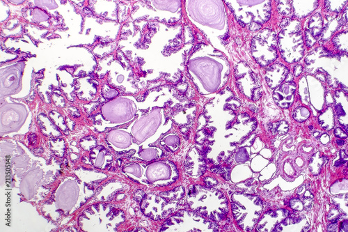 Benign prostatic hyperplasia. Micrograph shows dilated glands ...