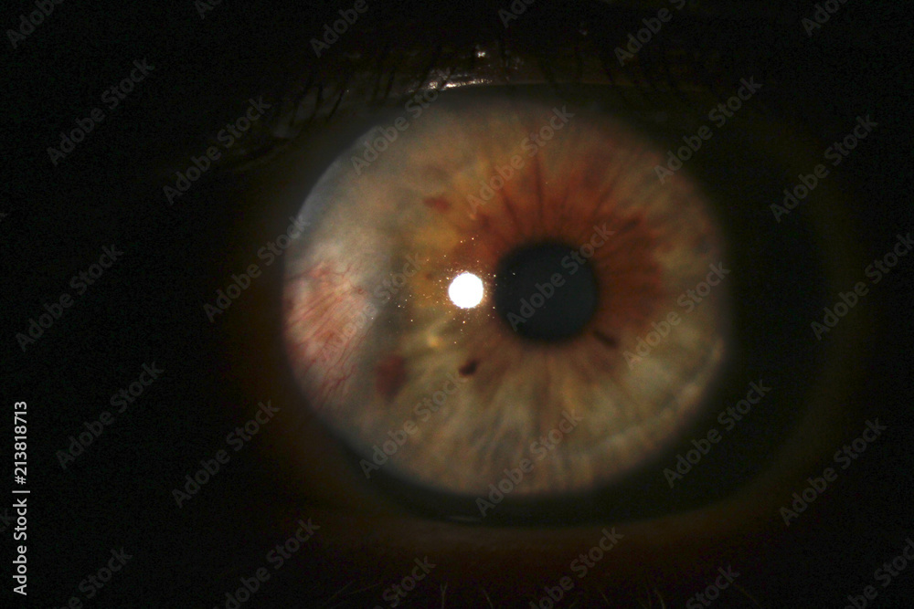 Human eye with cataract. Investigation and test of the eye fundus of ...